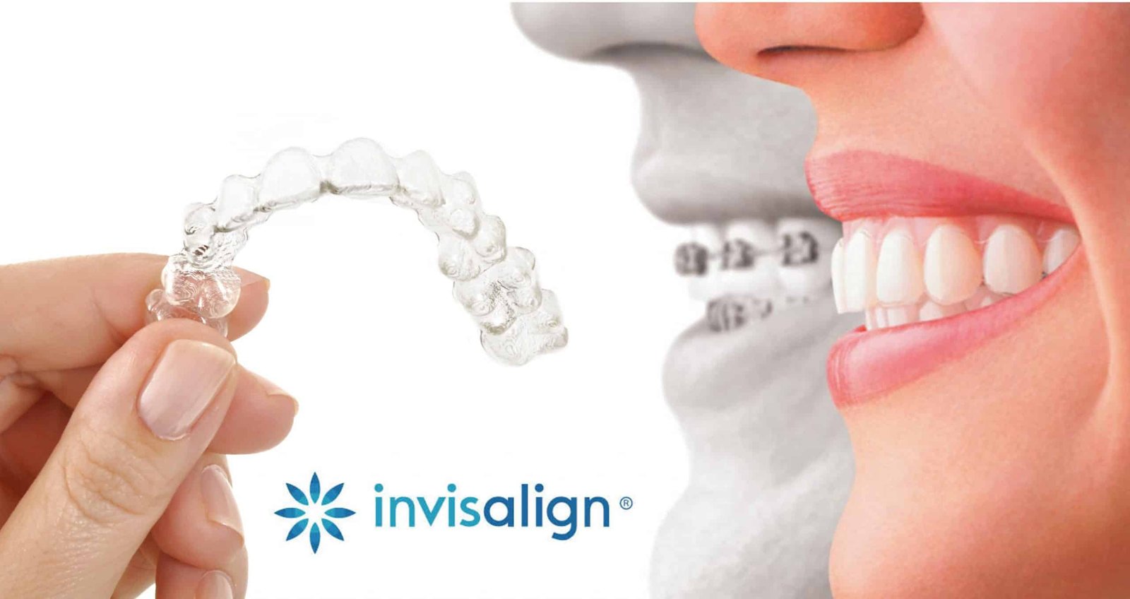 What is Invisalign? And Why Should You Care? - Billericay Dental Care